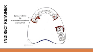APPLIED ASPECTS OF CAST PARTIAL DENTURE DESIGNING.pptx