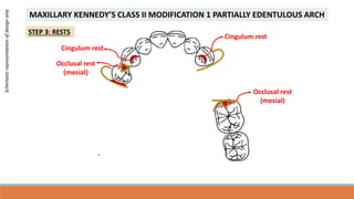 APPLIED ASPECTS OF CAST PARTIAL DENTURE DESIGNING.pptx