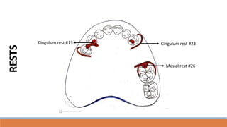 APPLIED ASPECTS OF CAST PARTIAL DENTURE DESIGNING pptx APPLIED ASPECTS OF CAST PARTIAL DENTURE DESIGNING pptx