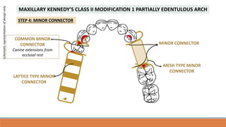 APPLIED ASPECTS OF CAST PARTIAL DENTURE DESIGNING.pptx