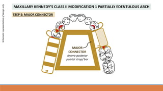 APPLIED ASPECTS OF CAST PARTIAL DENTURE DESIGNING.pptx