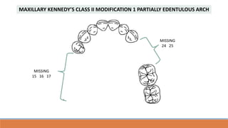 APPLIED ASPECTS OF CAST PARTIAL DENTURE DESIGNING.pptx