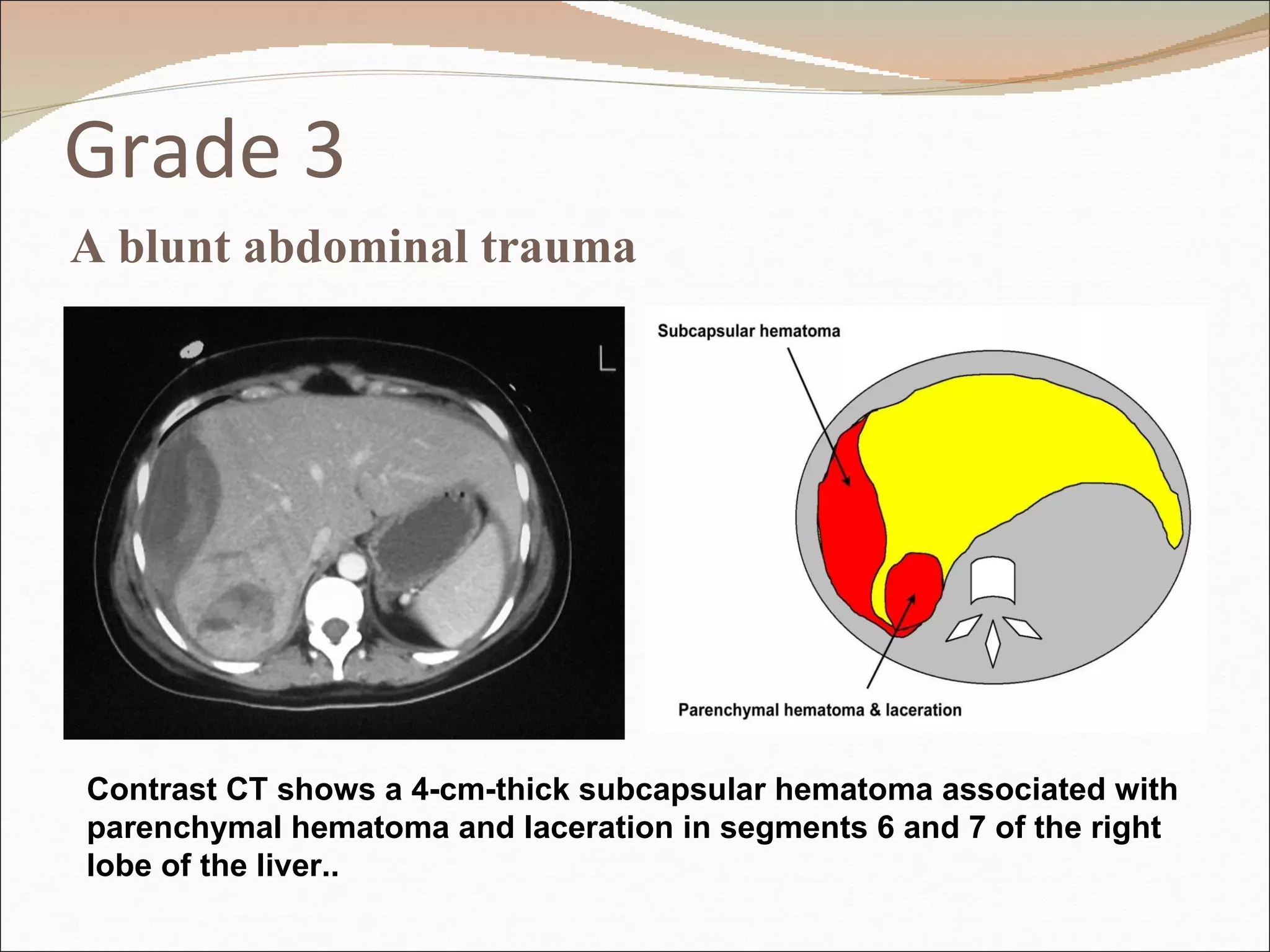 Liver Trauma | PPT