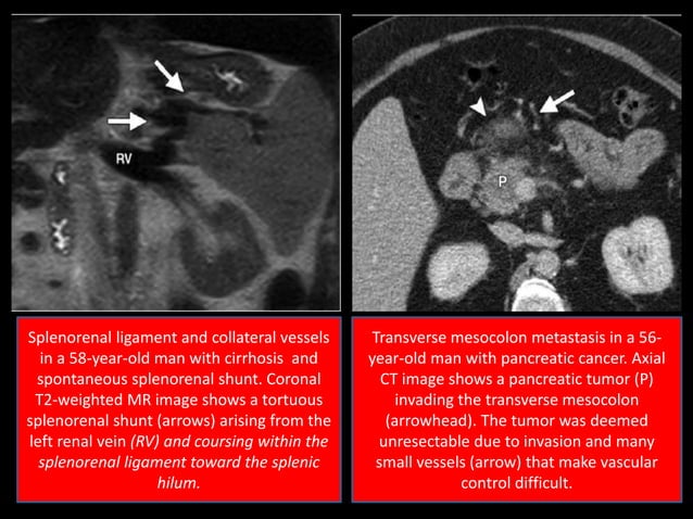 Applied radiological anatomy of retroperitoneum and peritoneal spaces ...