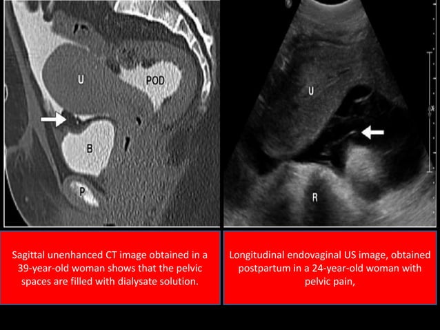 Applied radiological anatomy of retroperitoneum and peritoneal spaces ...