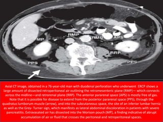 Applied radiological anatomy of retroperitoneum and peritoneal spaces ...