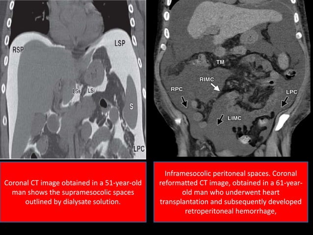 Applied radiological anatomy of retroperitoneum and peritoneal spaces | PPT