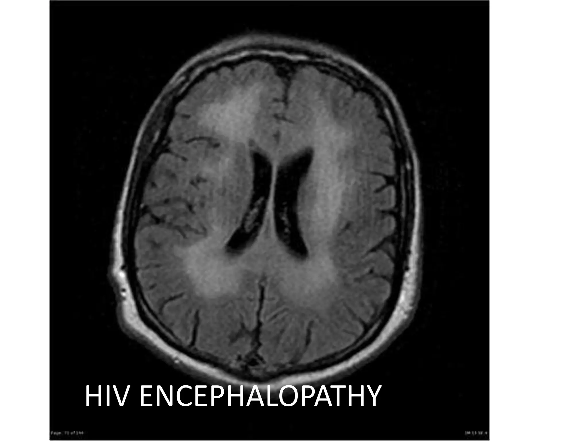 Apporach of brain lesion in hiv | PPTX