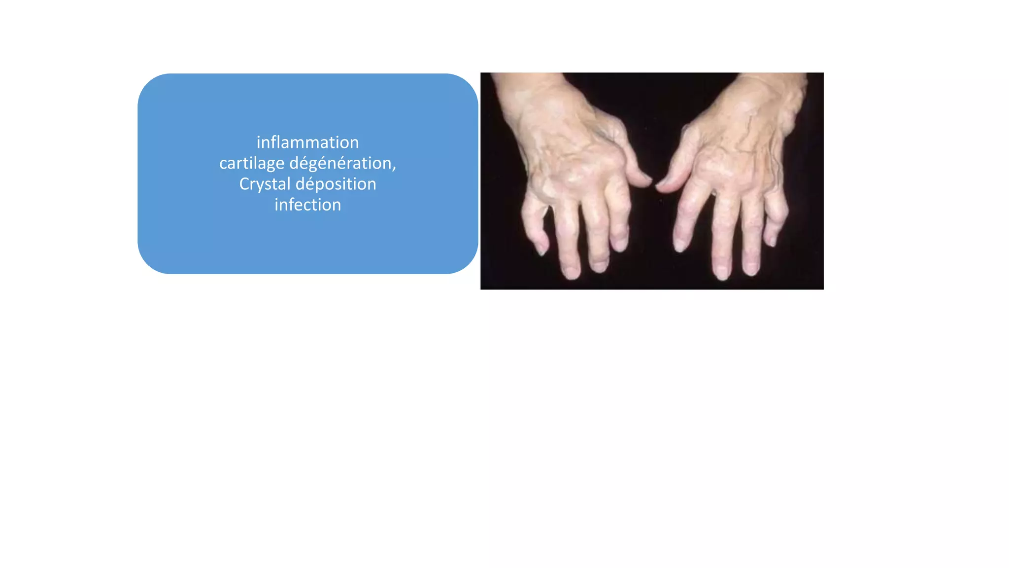 ATRAUMATIC JOINT SWELLING | PPTX