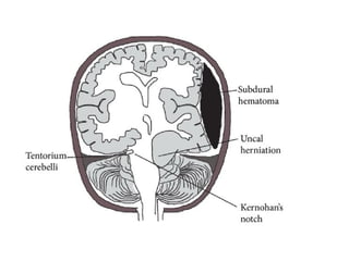 Approach coma coma coma approach coma.pptx