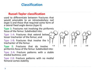 approach-to-fractures-managment-in-elderly-1-_1_.ppt