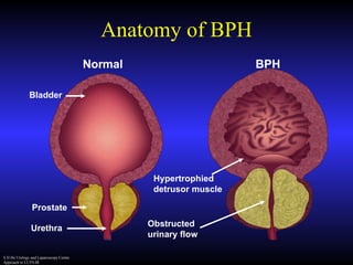 Family Physician's Approach to Lower Urinary Tract Symptoms | PPT