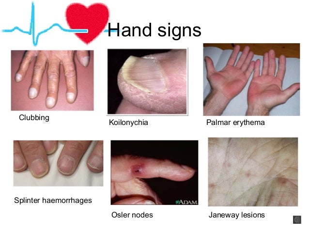 Infective Endocarditis Can You Remember The Signs Approach To The