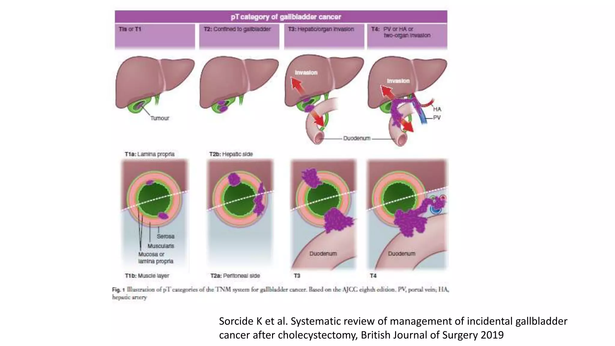 Approach and management of incidental carcinoma gallbladder | PPTX