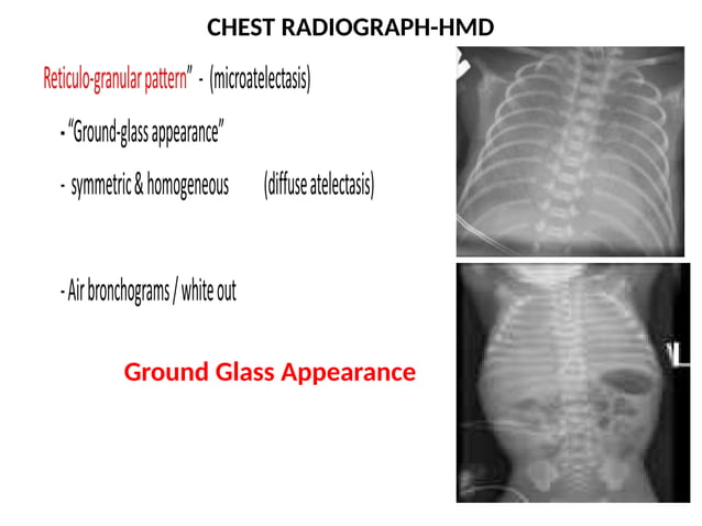 Approach a respiratory distress in Premature babies.pptx