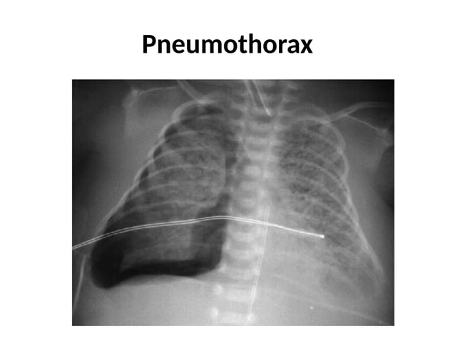 Approach a respiratory distress in Premature babies.pptx