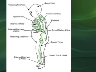 Approach to childhood rickets | PPTX