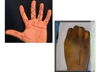 Hand incision Approaches ortho plastic.ppt