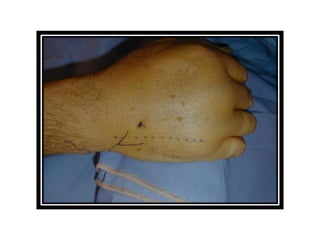 Hand incision Approaches ortho plastic.ppt