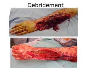 Hand incision Approaches ortho plastic.ppt