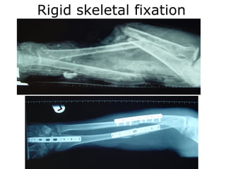 Hand incision Approaches ortho plastic.ppt