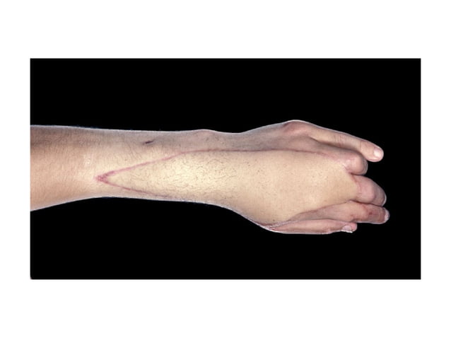 Hand incision Approaches ortho plastic.ppt