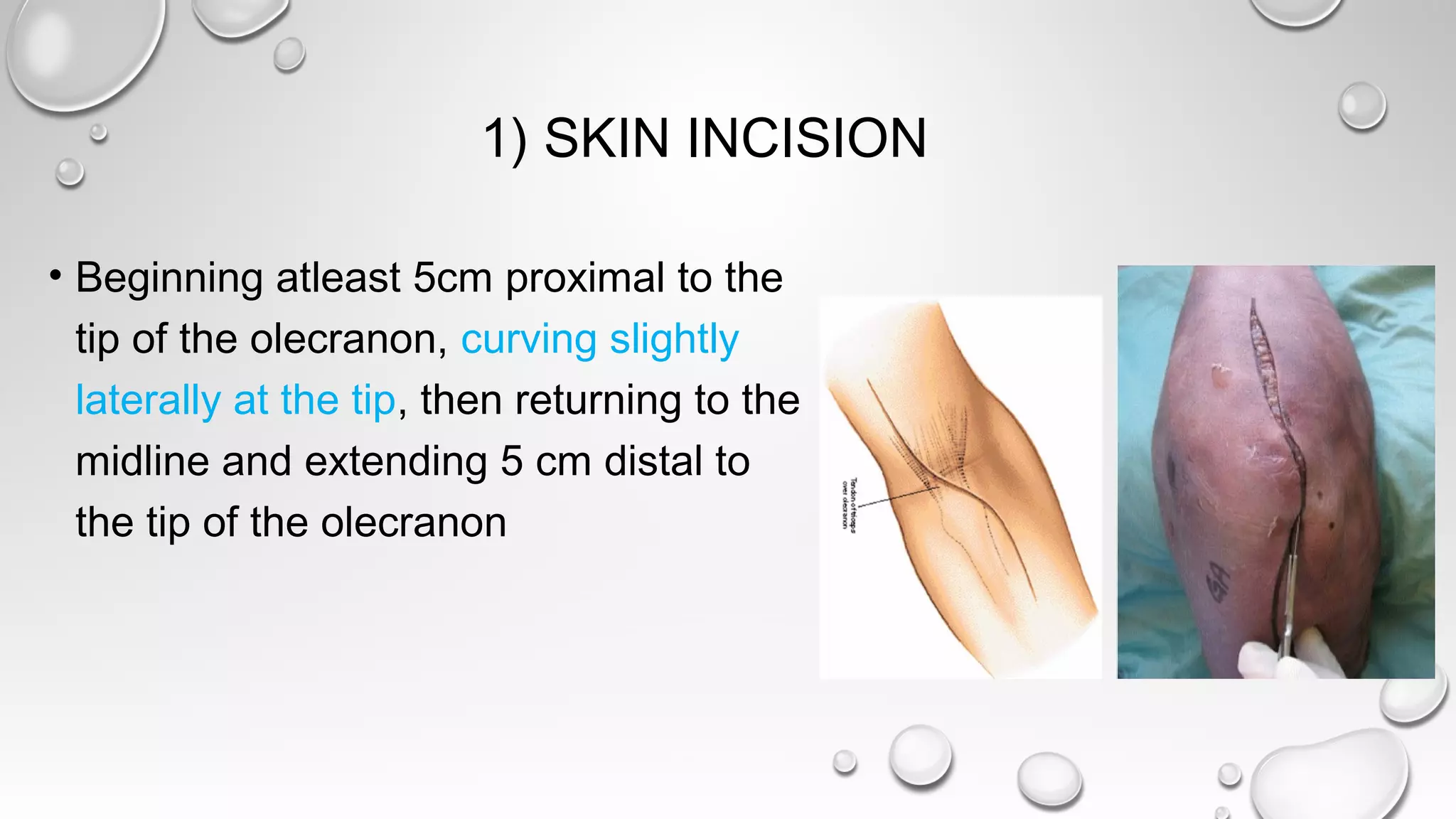 Surgical Approaches to distal humerus fractures - DR.S.SENTHIL SAILESH ...