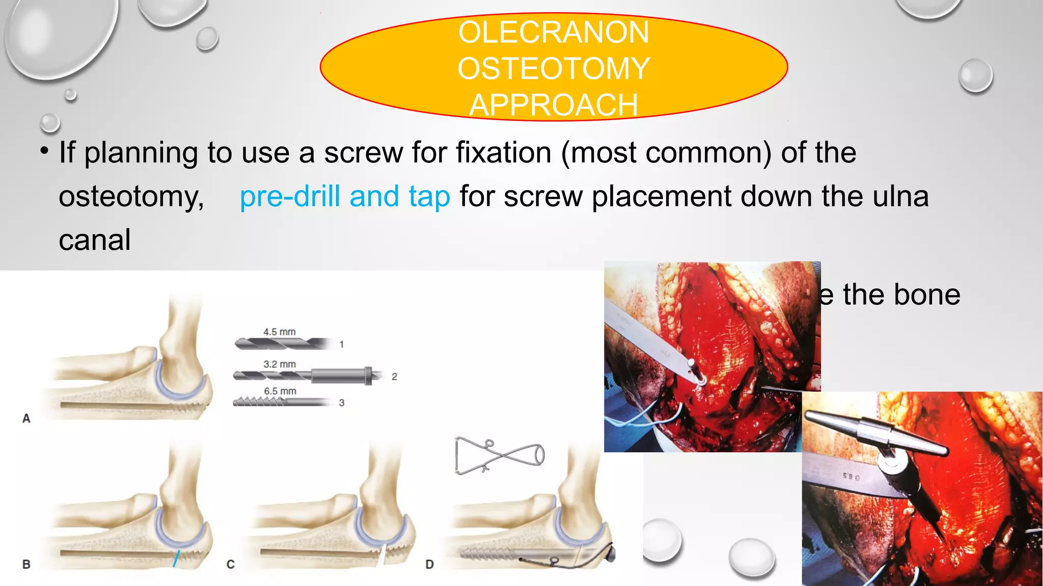 Surgical Approaches to distal humerus fractures - DR.S.SENTHIL SAILESH ...