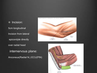Approaches of elbow | PPTX | Death, Injury, or Military Conflict ...