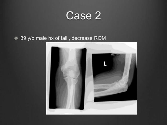 Approaches of elbow | PPTX | Death, Injury, or Military Conflict ...