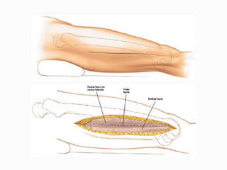 Approaches of femur | PPT