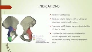 Approaches to Acetabulum- Dr Sharan | PPTX | Death, Injury, or Military ...