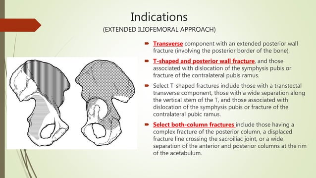 Approaches to Acetabulum- Dr Sharan | PPTX | Death, Injury, or Military ...
