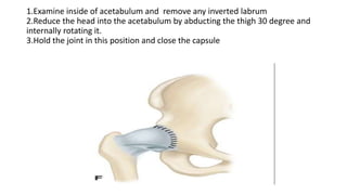 Approaches to hip joint | PPTX