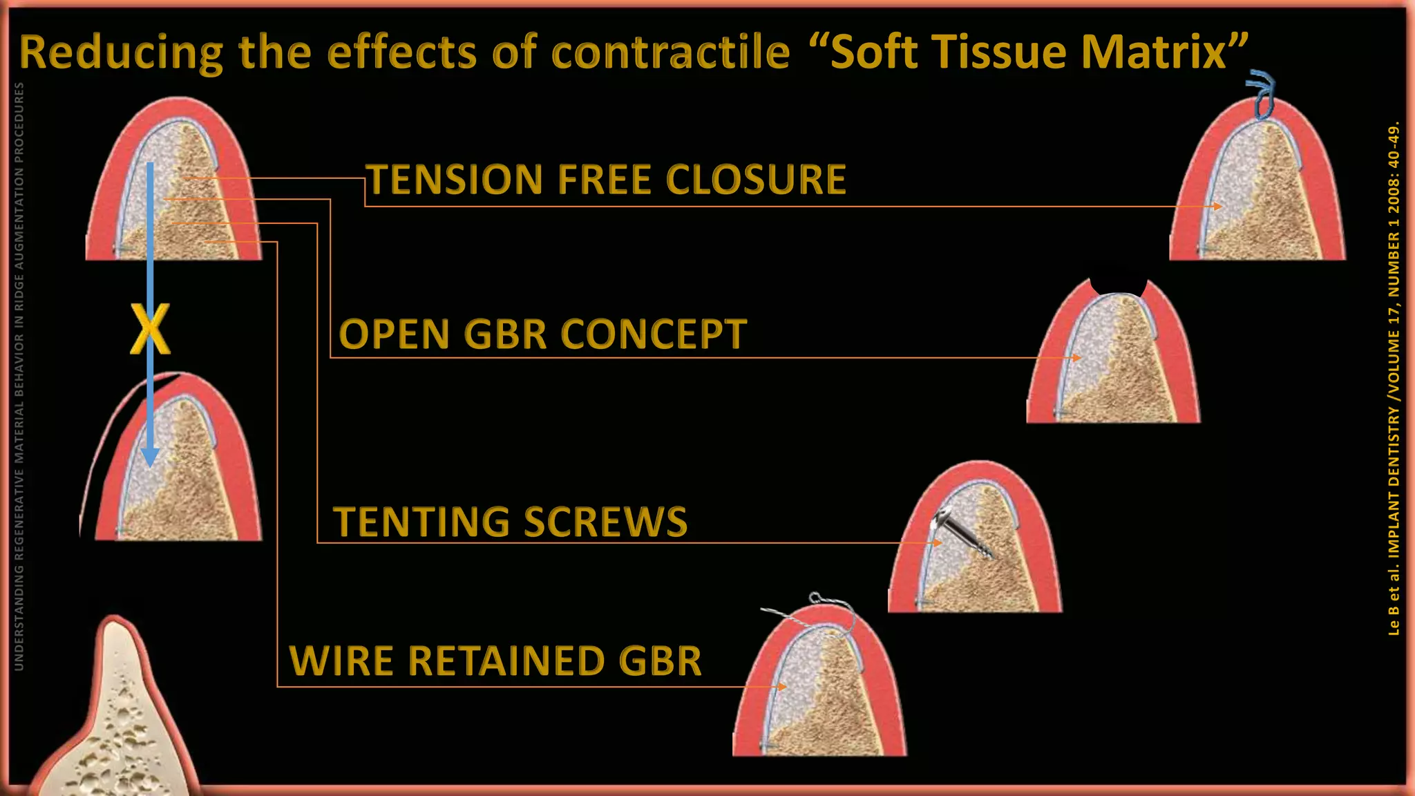 Approaches to ridge augmentation | PPTX