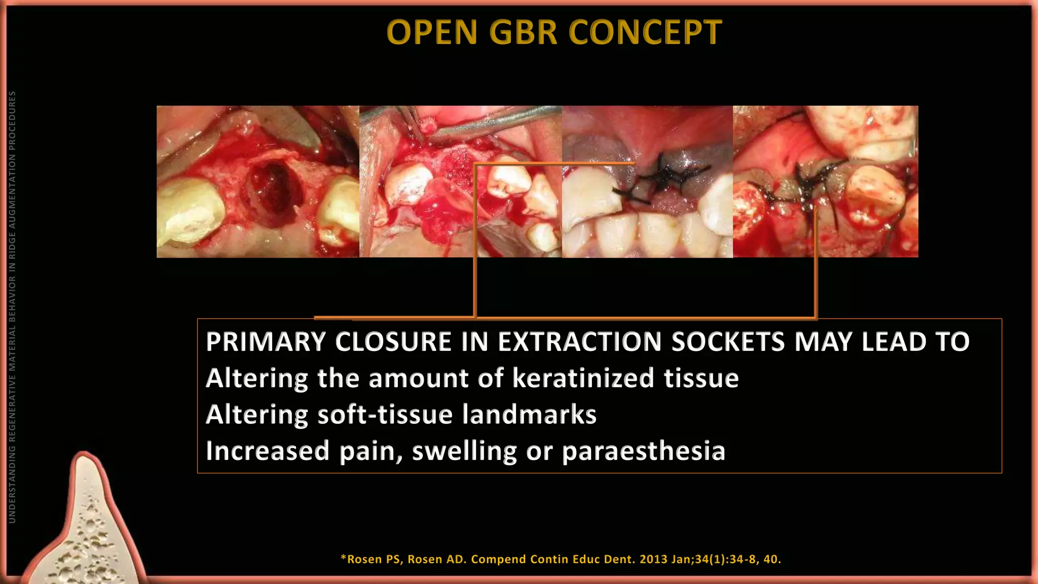 Approaches to ridge augmentation | PPTX
