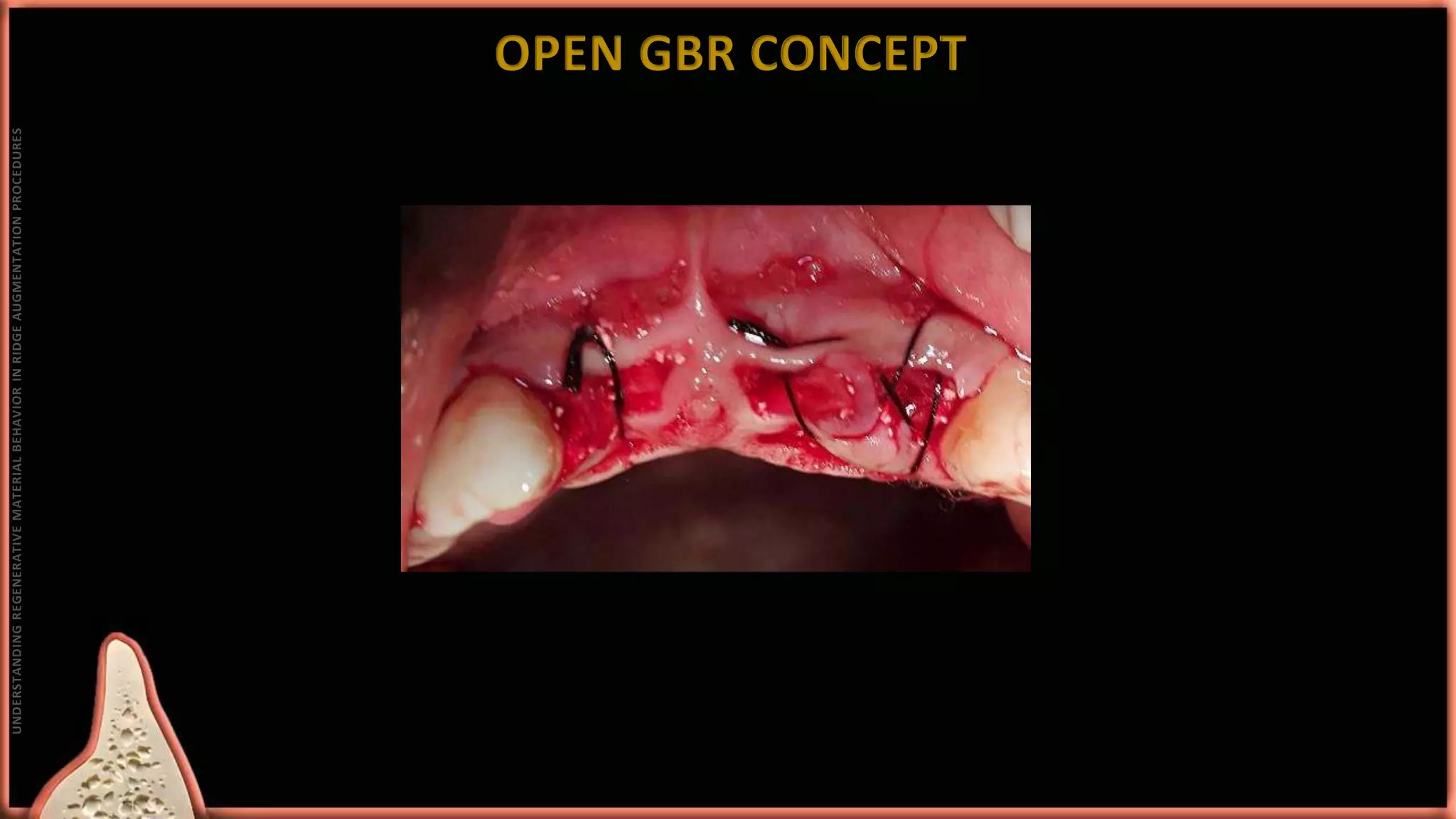 Approaches to ridge augmentation | PPTX