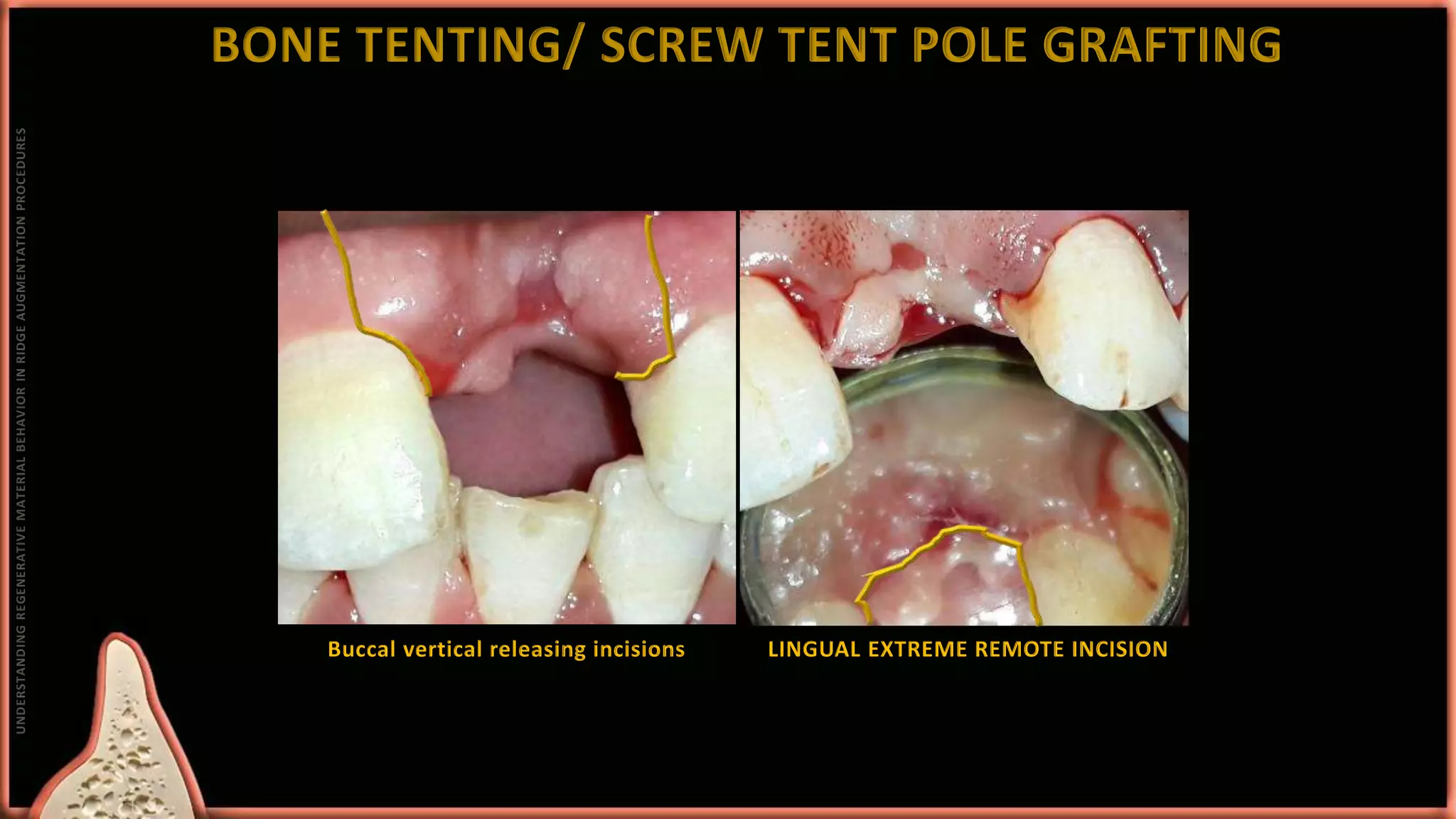 Approaches to ridge augmentation | PPTX