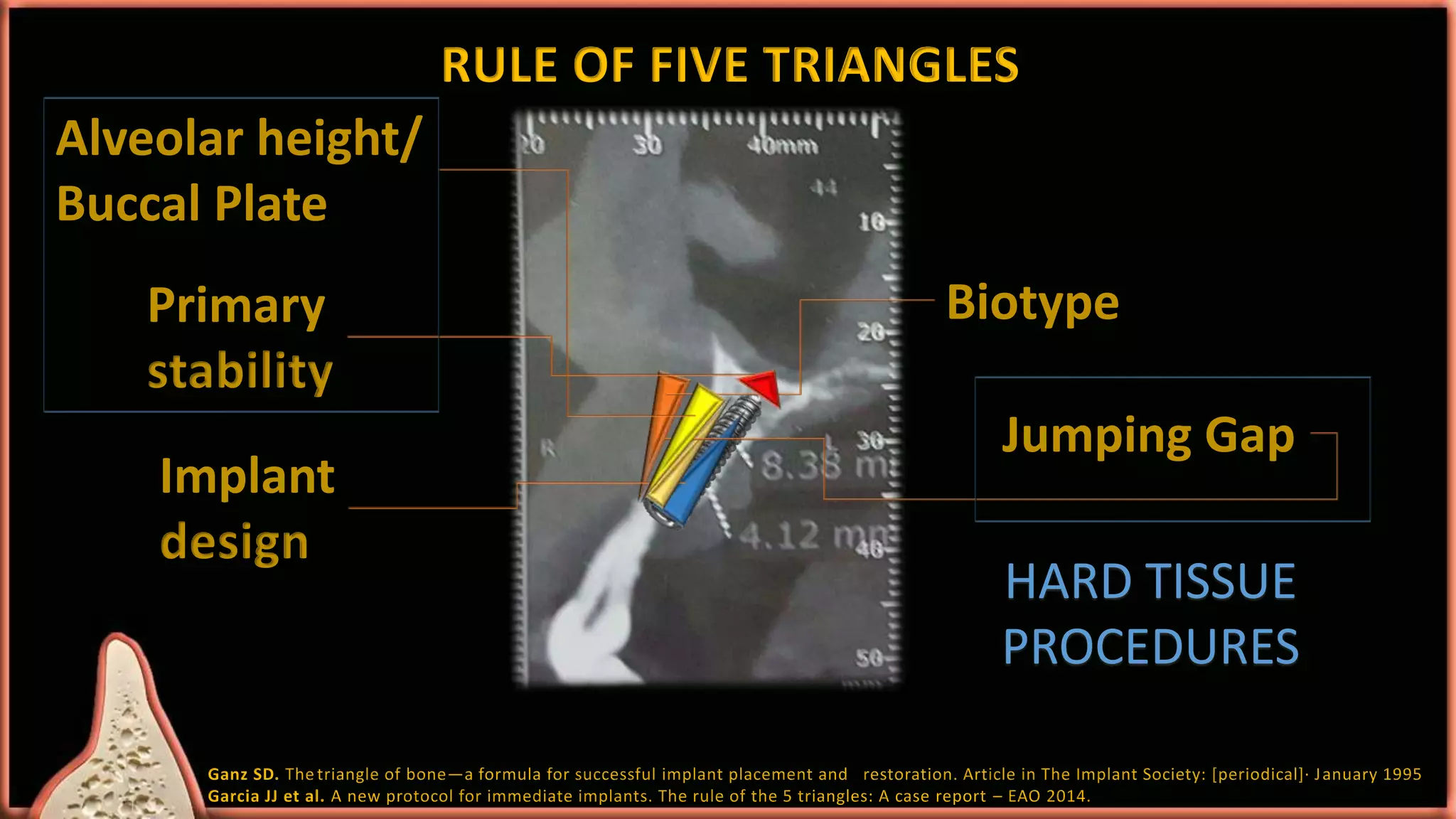 Approaches to ridge augmentation | PPTX