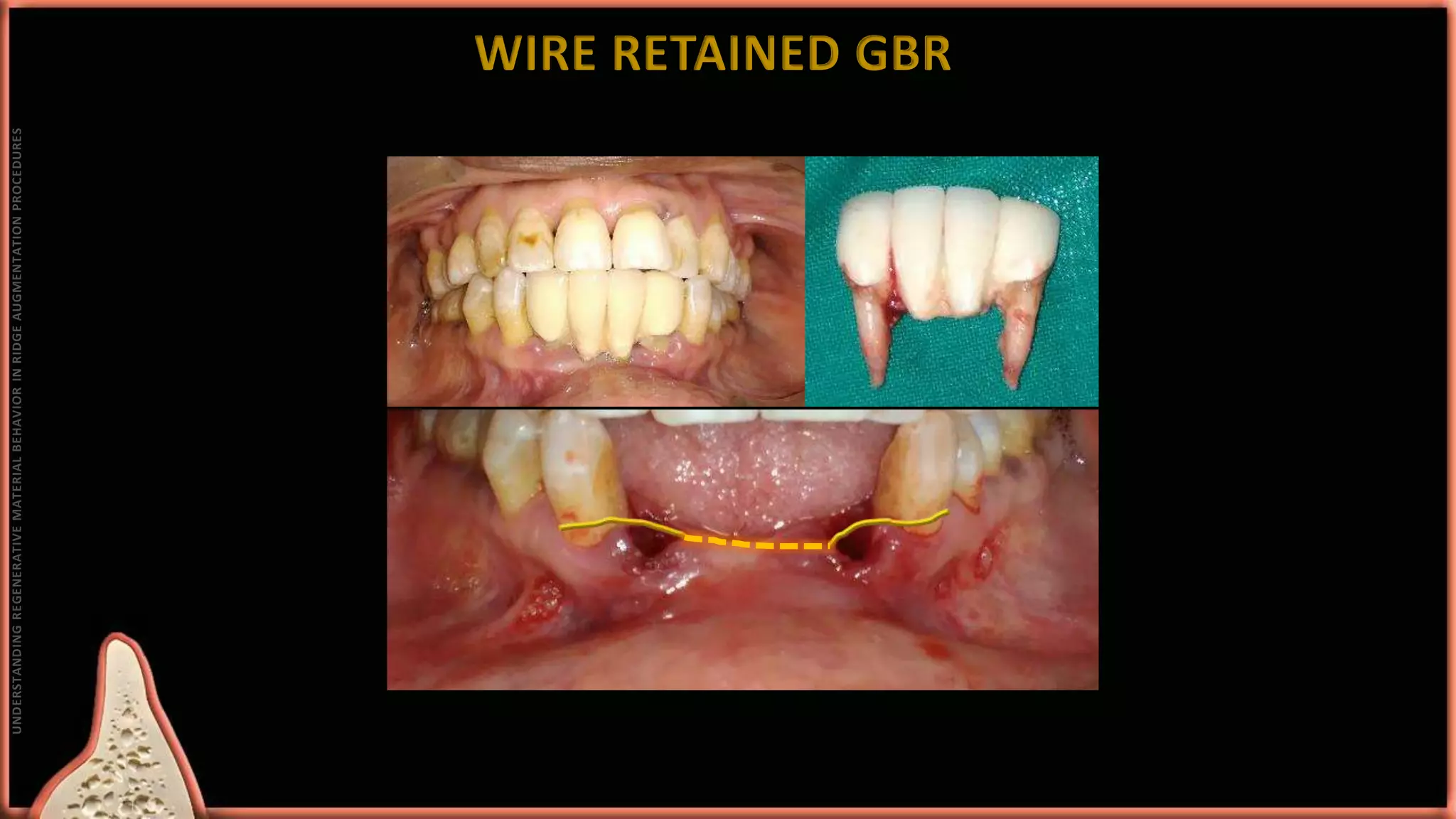 Approaches to ridge augmentation | PPTX