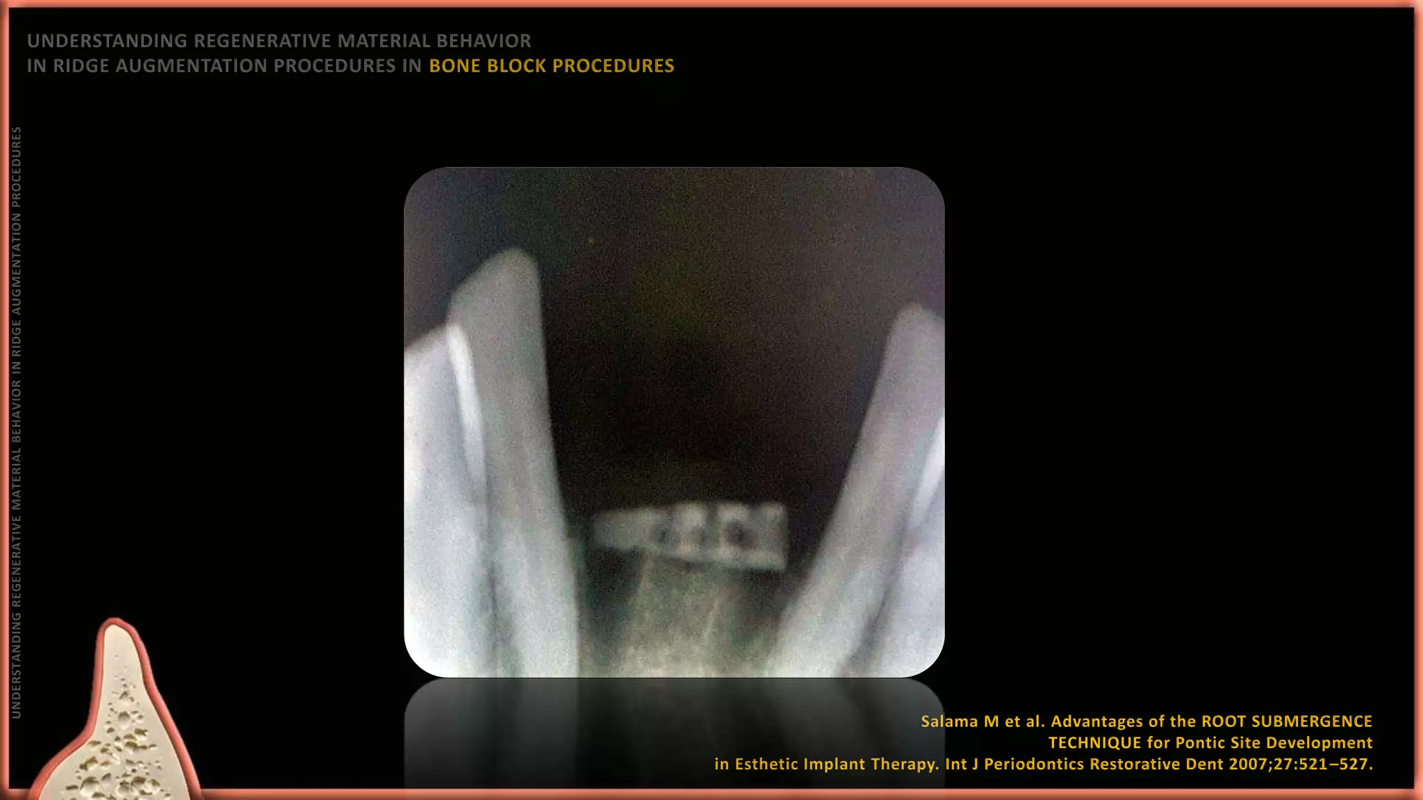 Approaches to ridge augmentation | PPTX