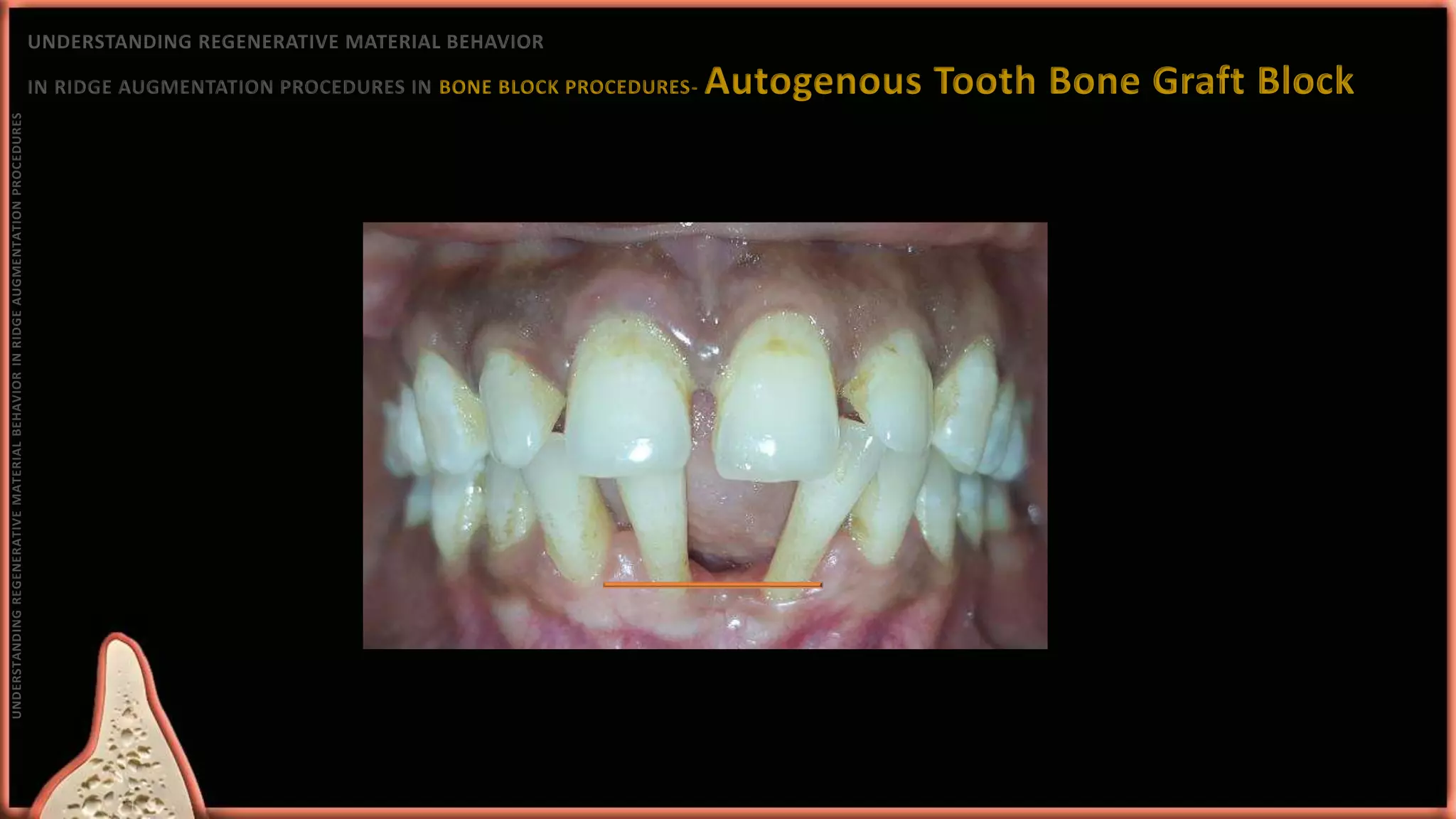 Approaches to ridge augmentation | PPTX