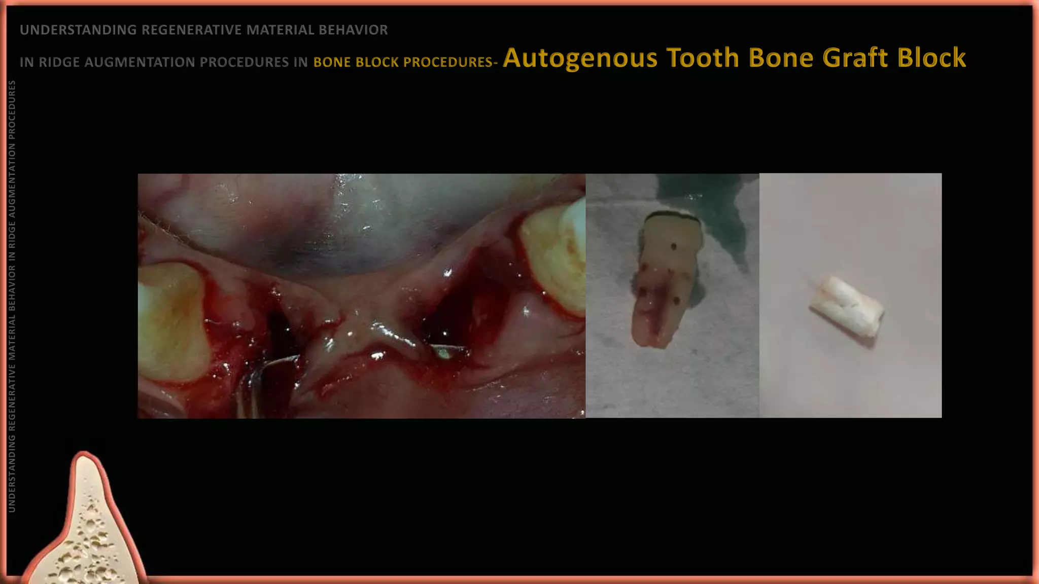 Approaches to ridge augmentation | PPTX