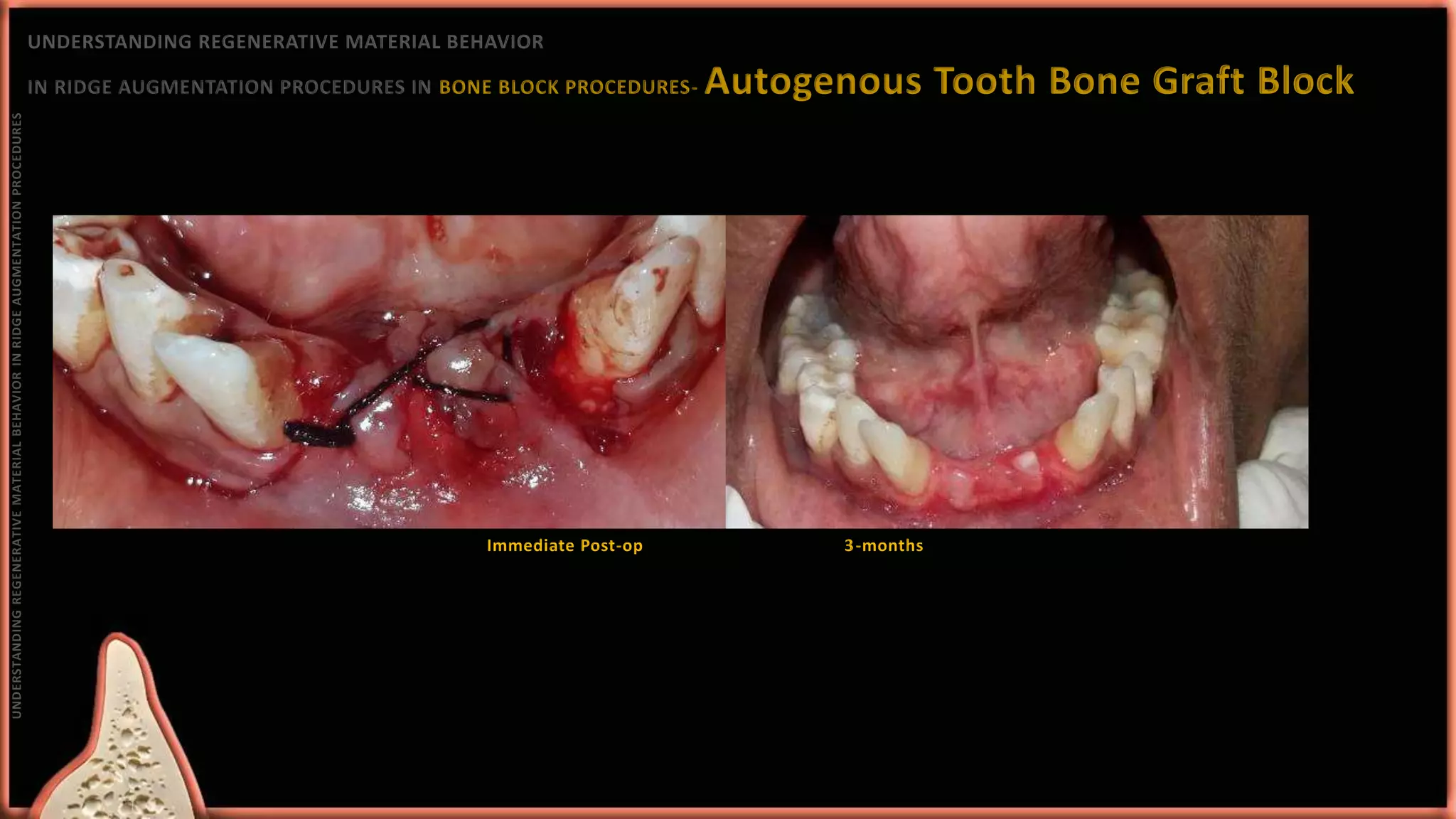 Approaches to ridge augmentation | PPTX