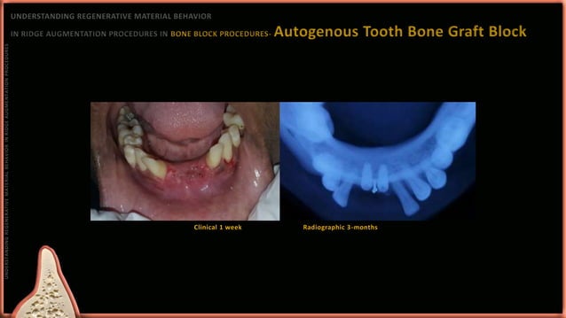 Approaches to ridge augmentation | PPTX | Dental Health | Diseases and ...