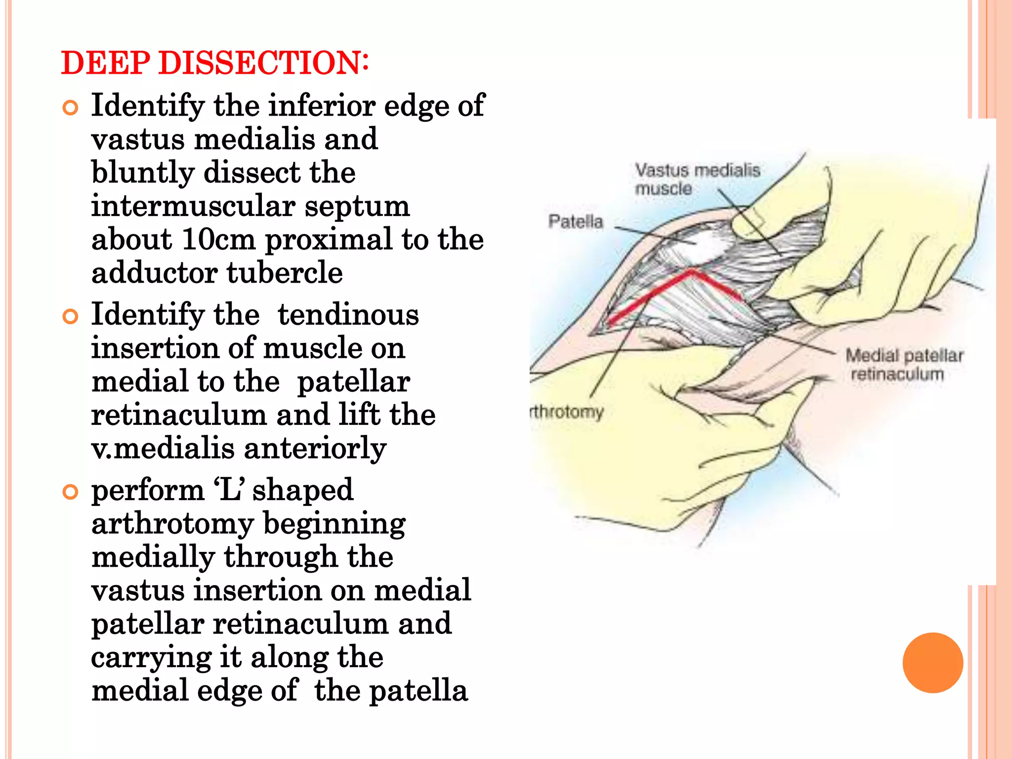 surgical approaches of knee joint | PPTX