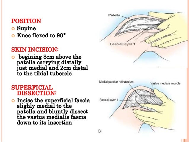 surgical approaches of knee joint