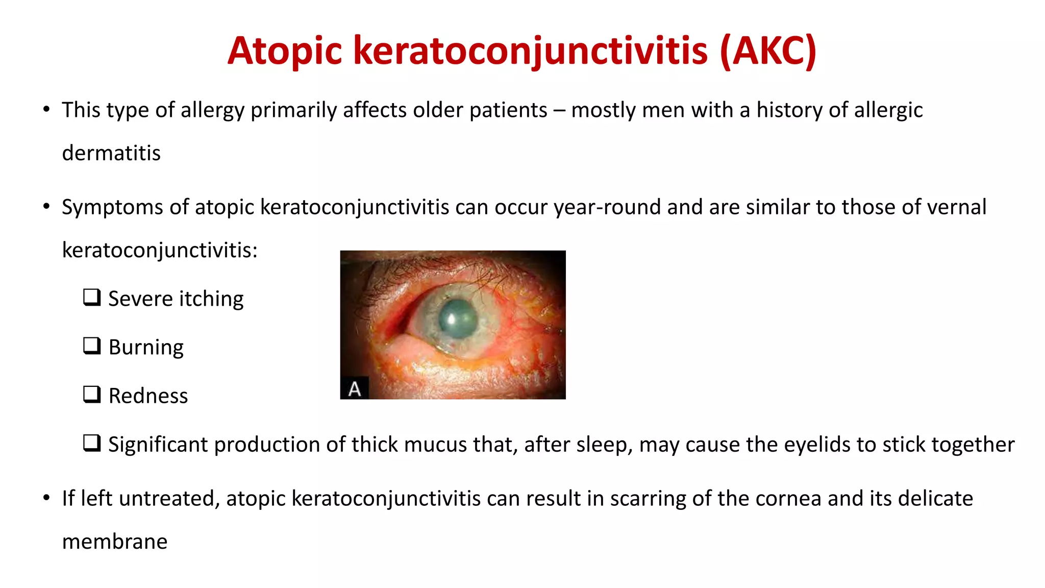 approachforcommoneyeallergy 1.pptx