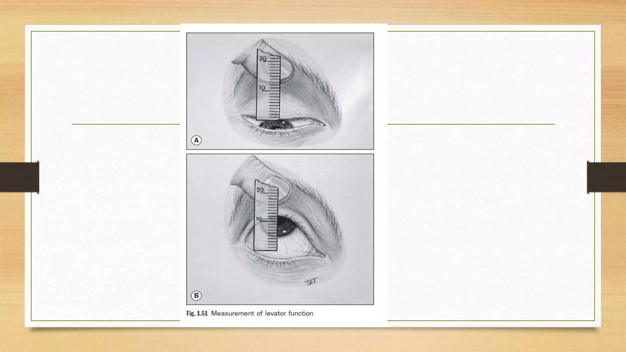 Approach for ptosis | PPTX
