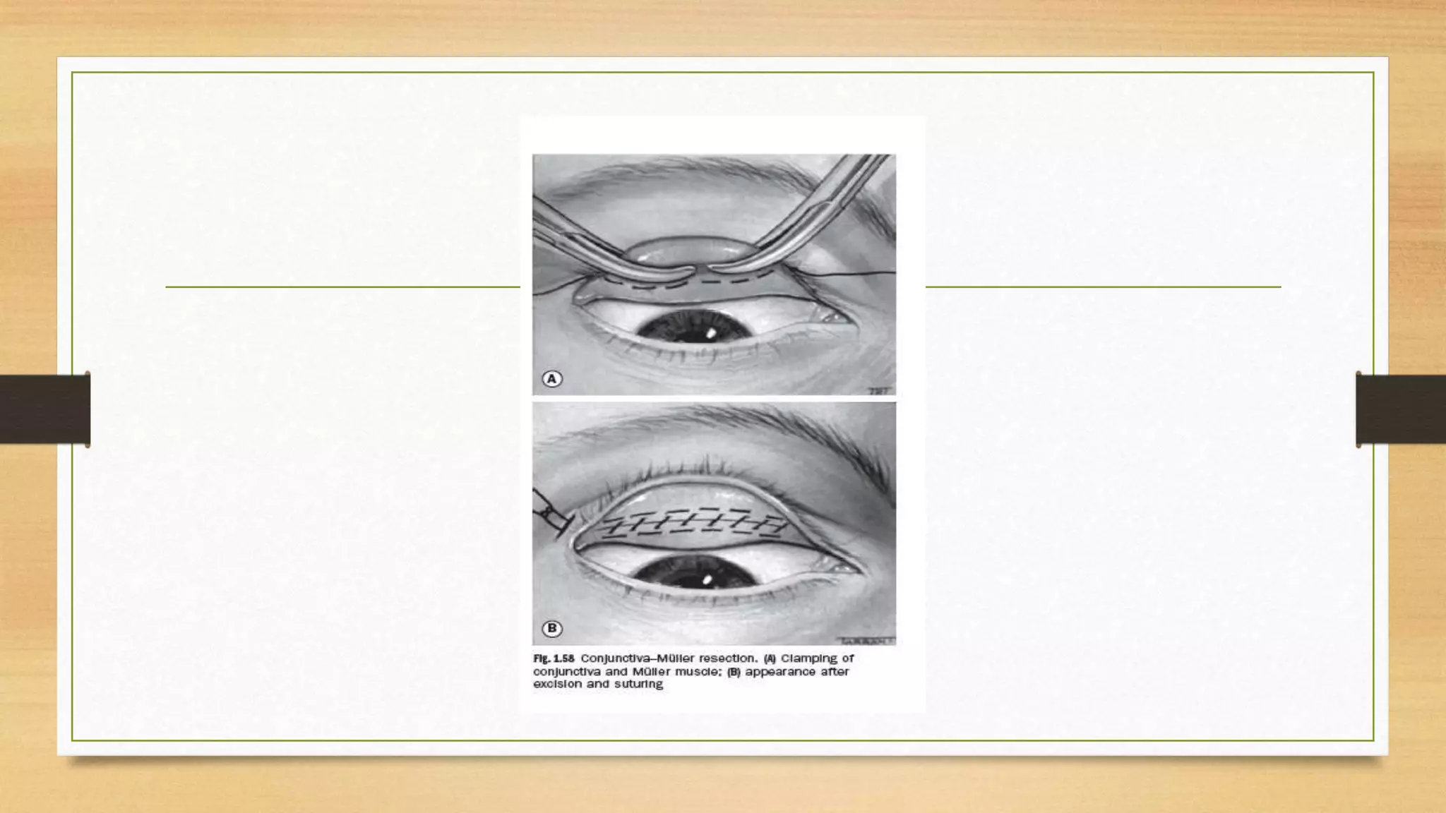 Approach for ptosis | PPTX